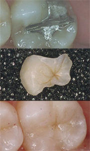 Alternatives to Crowns - World Class Dentistry | Sarasota Dentists